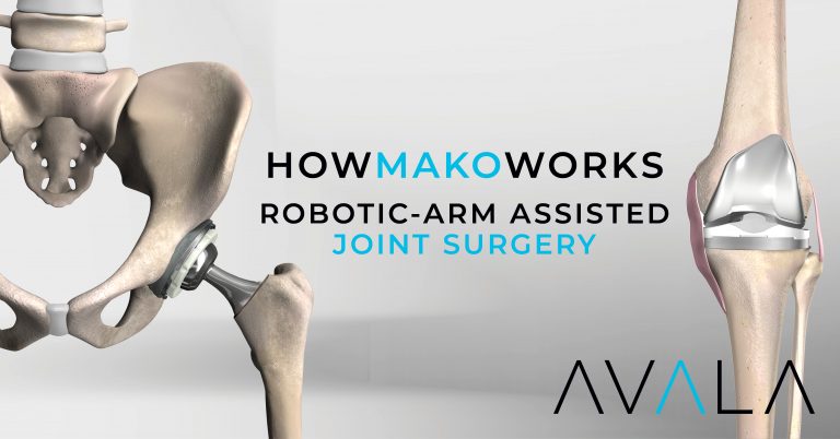 How Mako Robotic-arm Assisted Surgery Works - AVALA
