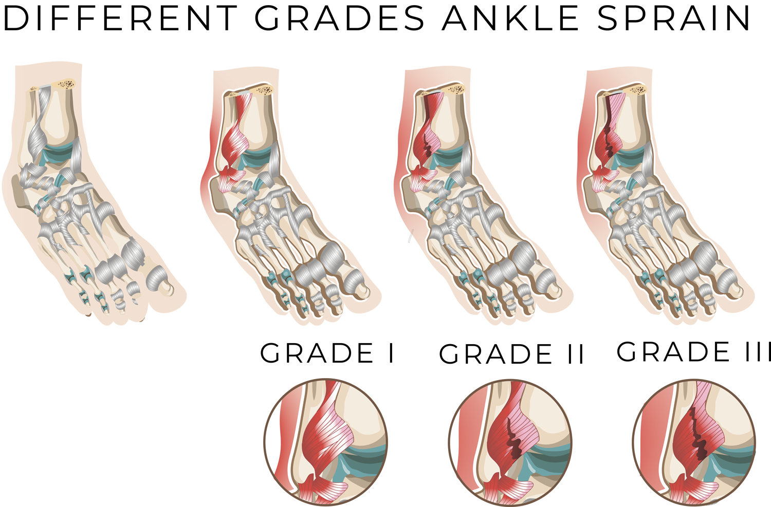 Grade 3 Sprain Grade 3 Sprain